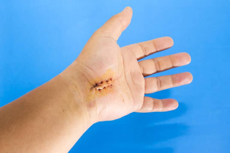 What to Expect When Recovering From Hand Surgery | The Orthopaedic Center